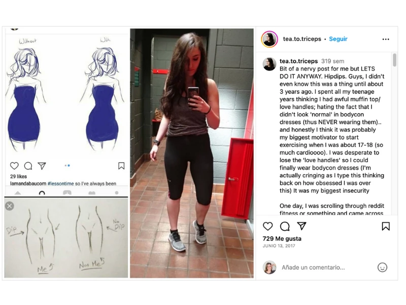 Hip Dips » Cirujana Plástica Patricia Mancebo